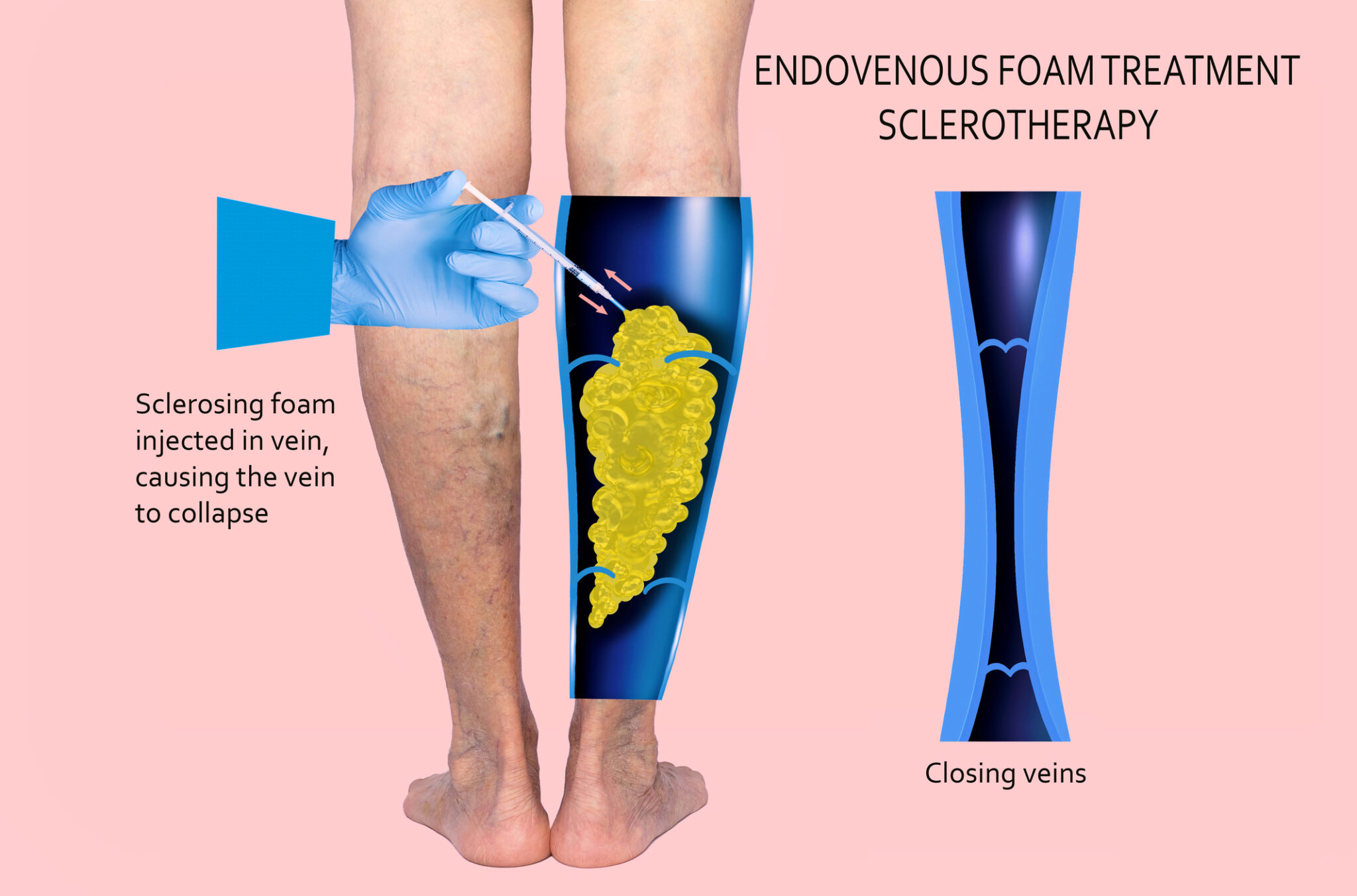 Erase Varicose & Spider Veins With These 7 Treatments - CIS