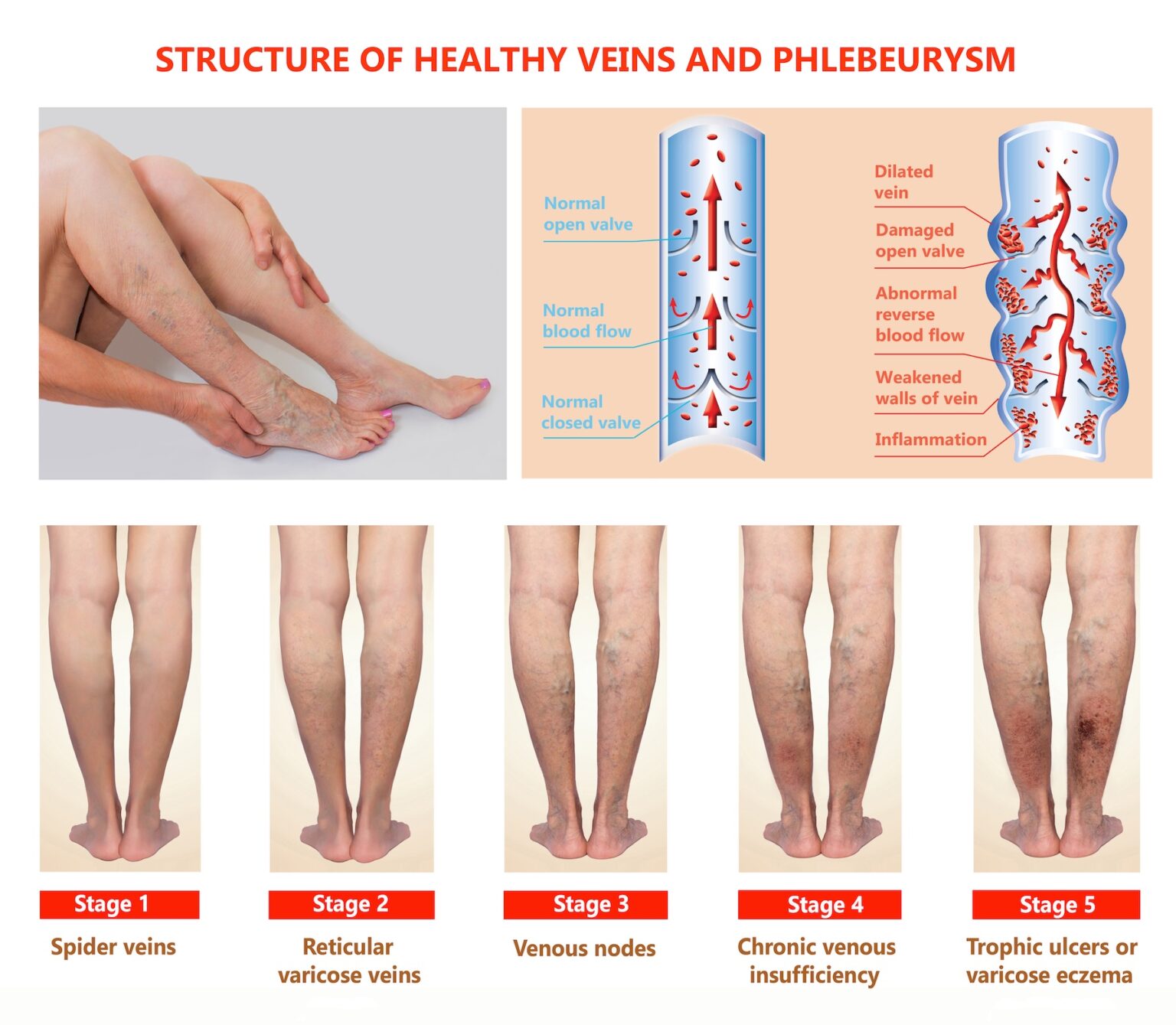 Causes, Symptoms, & Treatments For Chronic Venous Insufficiency