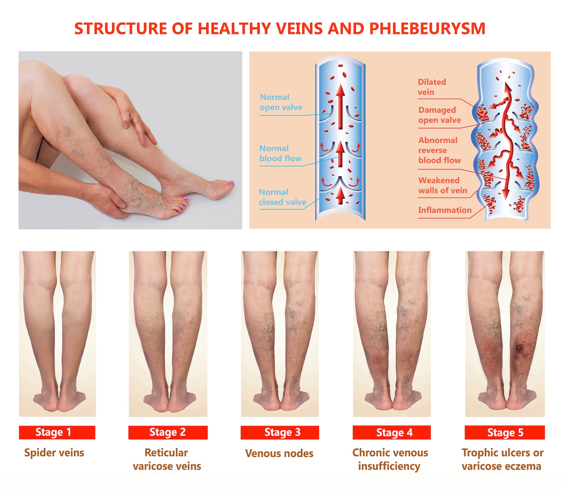 Chronic Venous Insufficiency Causes, Symptoms, & Treatments